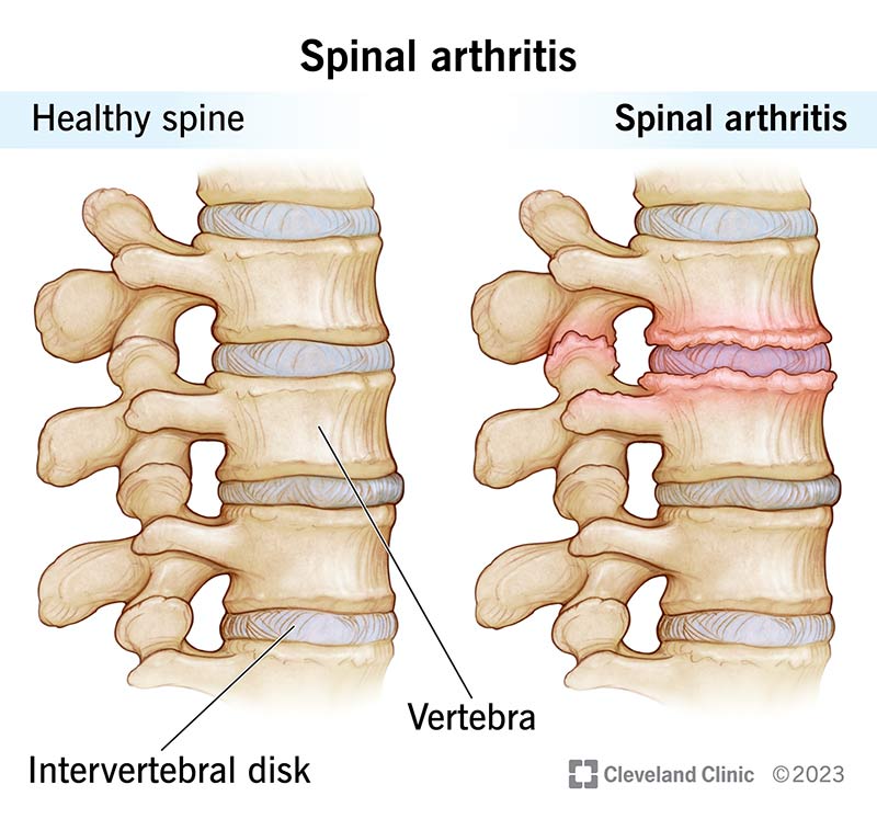 Hisar’s Leading Spondylosis Treatment – Expert Solutions for Spine ...